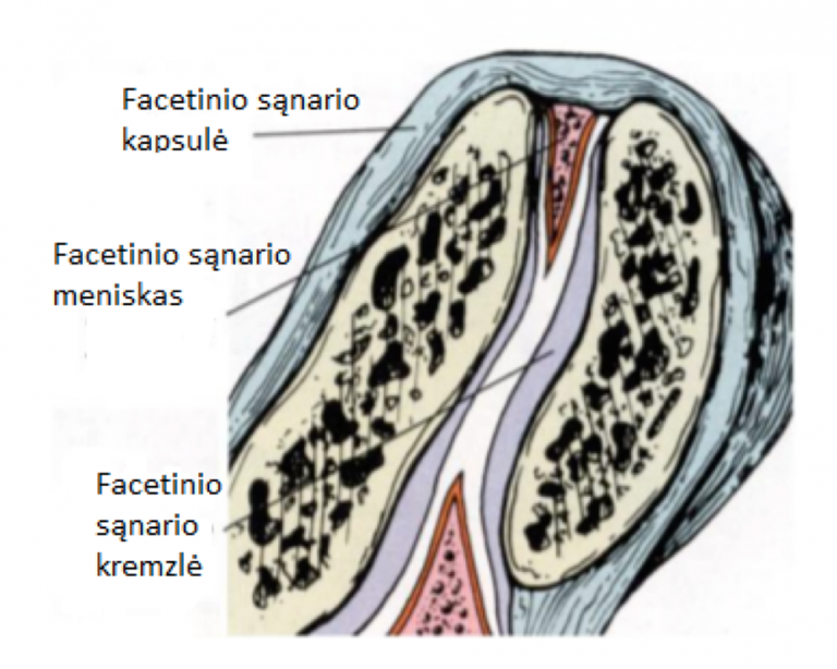 Artropatinės kilmės juosmens skausmas - Osteomedika